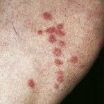 Flohstich - Altmeyers Enzyklopädie - Fachbereich Dermatologie