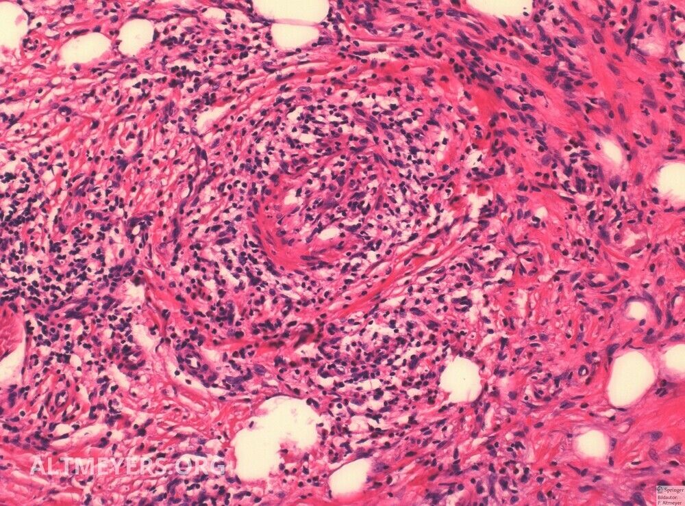 Erythema Induratum Histology