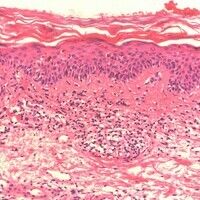 Erythema gyratum repens Bilder - Altmeyers Enzyklopädie - Fachbereich ...