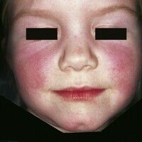 Erythema infectiosum Bilder - Altmeyers Enzyklopädie - Fachbereich ...
