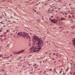 Erythema nodosum - Altmeyers Enzyklopädie - Fachbereich Dermatologie