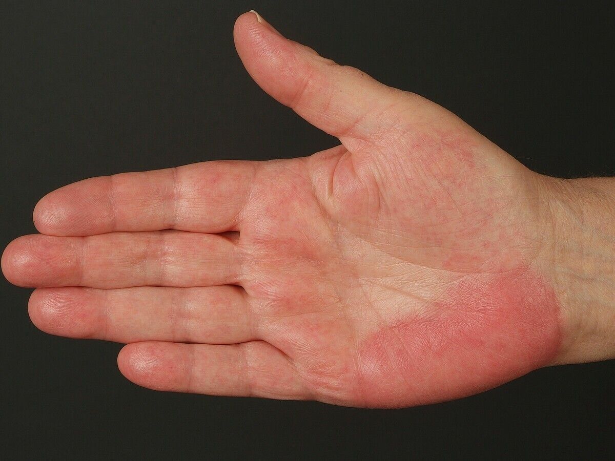 Erythema Hands erythema-hands