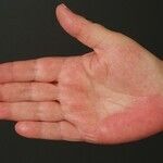 Erythema palmare et plantar symptomaticum - Altmeyers Encyclopedia ...