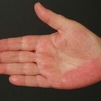 Erythema palmare et plantare symptomaticum Bilder - Altmeyers ...