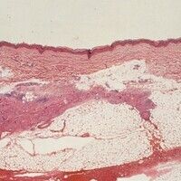 Erythema nodosum Images - Altmeyers Encyclopedia - Department Dermatology