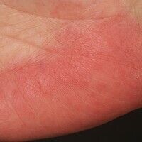 Erythema palmare et plantare symptomaticum Bilder - Altmeyers ...