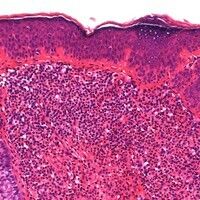 Facial granuloma Images - Altmeyers Encyclopedia - Department Dermatology