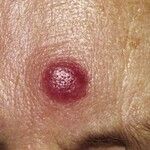Facial granuloma - Altmeyers Encyclopedia - Department Dermatology