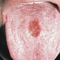 Gumma Images - Altmeyers Encyclopedia - Department Dermatology