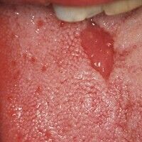 Glossitis rhombica mediana Bilder - Altmeyers Enzyklopädie ...