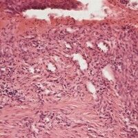 Granulation tissue Images - Altmeyers Encyclopedia - Department Dermatology