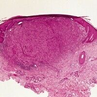 Dermatofibrom Bilder - Altmeyers Enzyklopädie - Fachbereich Dermatologie