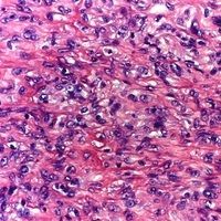 Dermatofibrom Bilder - Altmeyers Enzyklopädie - Fachbereich Dermatologie