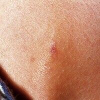 Neck fistula and cyst, lateral Images - Altmeyers Encyclopedia ...