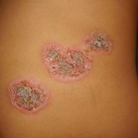Impetigo contagiosa, large-bubble Images - Altmeyers Encyclopedia ...
