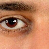 Hyperpigmentation postinflammatory Images - Altmeyers Encyclopedia ...