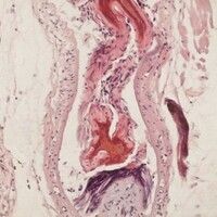 Hypertrichosen Bilder - Altmeyers Enzyklopädie - Fachbereich Dermatologie