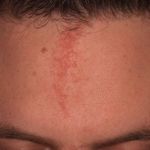 ILVEN - Altmeyers Enzyklopädie - Fachbereich Dermatologie