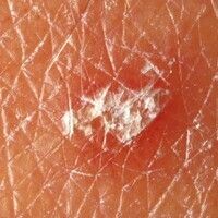 Candle spot phenomenon Bilder - Altmeyers Enzyklopädie - Fachbereich ...