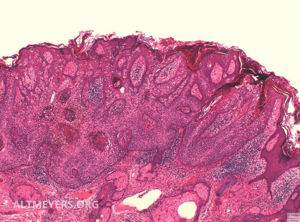 Clear Cell Acanthoma Histology