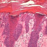 Actinic keratosis Images - Altmeyers Encyclopedia - Department Dermatology