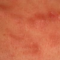 Leiomyom (Übersicht) Bilder - Altmeyers Enzyklopädie - Fachbereich ...