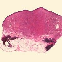 Leiomyosarcoma Images - Altmeyers Encyclopedia - Department Dermatology