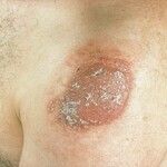 Old world cutaneous leishmaniasis - Altmeyers Encyclopedia - Department ...