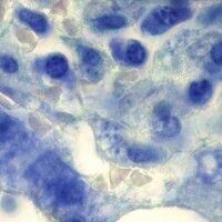 Visceral leishmaniasis Images - Altmeyers Encyclopedia - Department ...