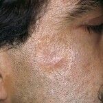 Old world cutaneous leishmaniasis - Altmeyers Encyclopedia - Department ...