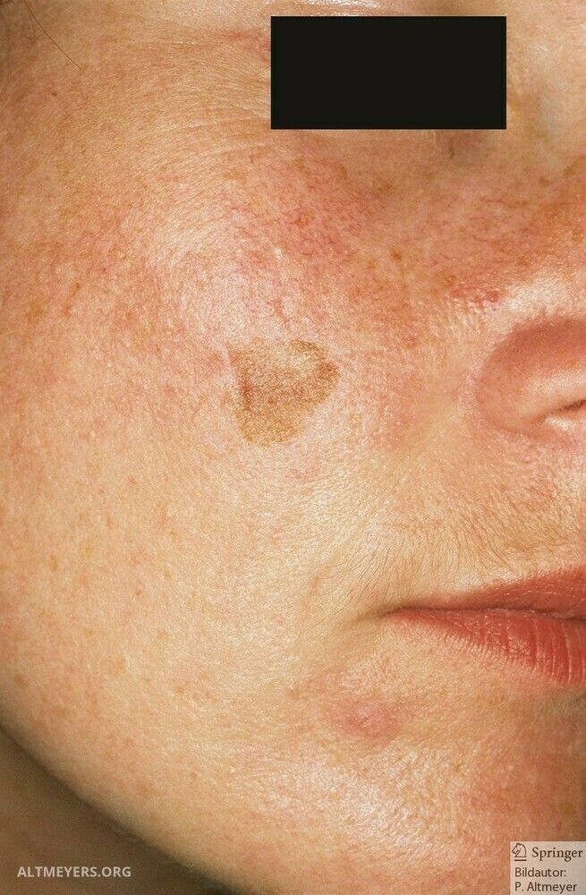 Solar Lentigo On Legs