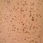 LEOPARD-Syndrom - Altmeyers Enzyklopädie - Fachbereich Dermatologie