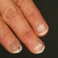 Leukonychia striata Bilder - Altmeyers Enzyklopädie - Fachbereich ...