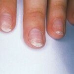 Leukonychie - Altmeyers Enzyklopädie - Fachbereich Dermatologie
