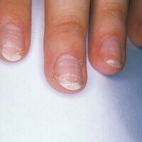 Bilder für Nagel, weiß - Altmeyers Enzyklopädie