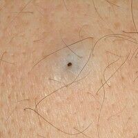 Komedo Bilder - Altmeyers Enzyklopädie - Fachbereich Dermatologie