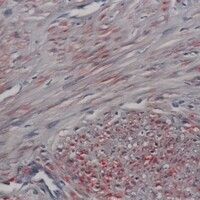 Leiomyom (Übersicht) Bilder - Altmeyers Enzyklopädie - Fachbereich ...