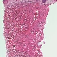 Leiomyom (Übersicht) Bilder - Altmeyers Enzyklopädie - Fachbereich ...