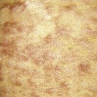 Leiomyom (Übersicht) Bilder - Altmeyers Enzyklopädie - Fachbereich ...