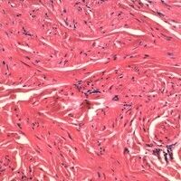 Leiomyom (Übersicht) Bilder - Altmeyers Enzyklopädie - Fachbereich ...