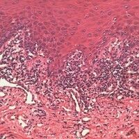 Lichen ruber mucosae Bilder - Altmeyers Enzyklopädie - Fachbereich ...