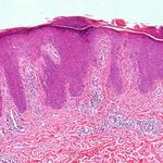 Lichen simplex chronicus - Altmeyers Encyclopedia - Department Dermatology