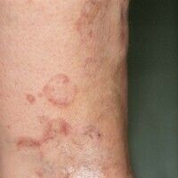 Lichen planus anularis Images - Altmeyers Encyclopedia - Department ...