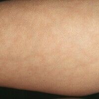 Livedo reticularis Images - Altmeyers Encyclopedia - Department Dermatology