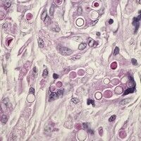 Lobomycosis Bilder - Altmeyers Enzyklopädie - Fachbereich Dermatologie