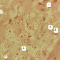 Lobomycosis Images - Altmeyers Encyclopedia - Department Dermatology