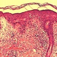 Polymorphic light eruption Images - Altmeyers Encyclopedia - Department ...