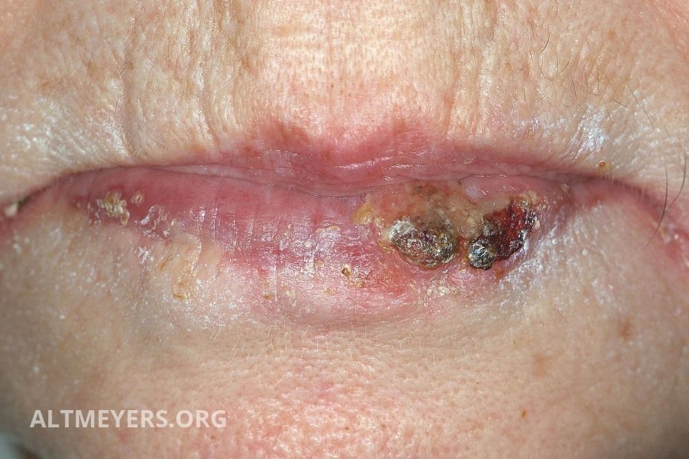 Verrucous Carcinoma Lip 