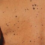 Keratosis seborrhoic (papillomatous type) - Altmeyers Encyclopedia ...
