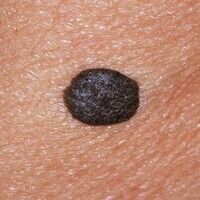 Keratosis seborrhoic (papillomatous type) Images - Altmeyers ...